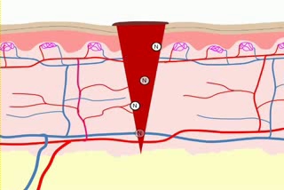 Mekanisme Terjadinya Radang