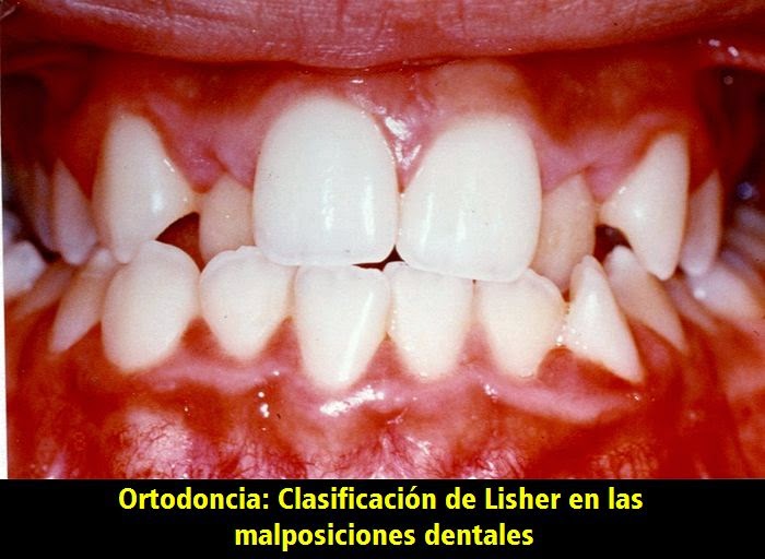 ORTODONCIA: Clasificación de Lisher en las Malposiciones Dentales - Ovi ...