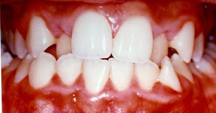 ORTODONCIA: Clasificación de Lisher en las Malposiciones Dentales - Ovi ...