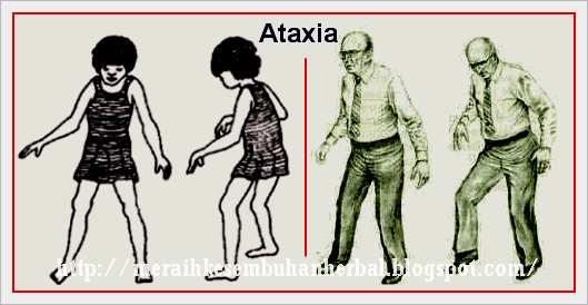 Meraih Kesembuhan Bersama Ace Maxs: Obat Ataksia Tradisional