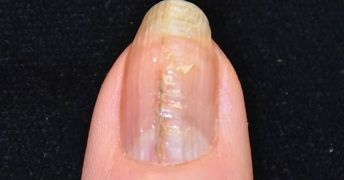 VIRTUAL GRAND ROUNDS IN DERMATOLOGY 2.0: Median Nail Dystrophy