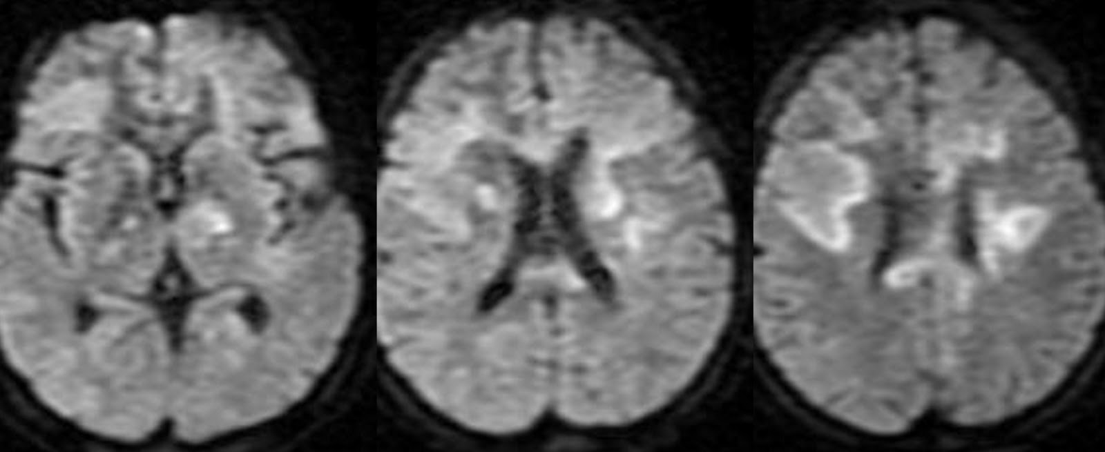 Dr Balaji Anvekar FRCR: Progressive Multifocal Leukoencephalopathy (PML)