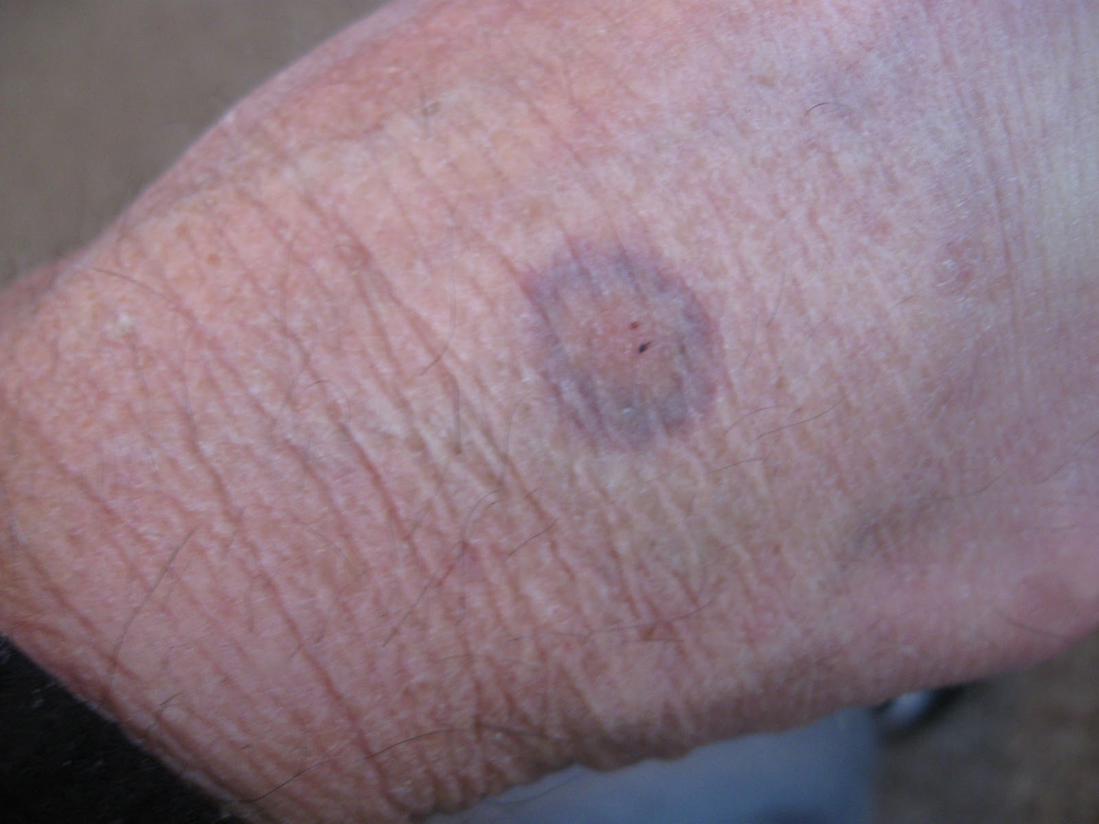 Dave's Notes from All Over: Spider Bite or Tick Bite