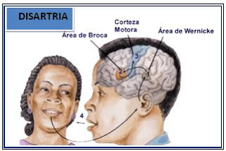 TRASTORNOS DE LENGUAJE Y COMUNICACION: DISARTRIA