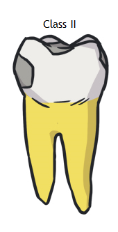 Dentasource: G. V. Black's Classification of Tooth Decay