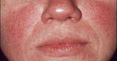 Primary Polycythemia Vera