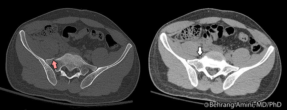 Roentgen Ray Reader: Denis Classification of Sacral Fractures