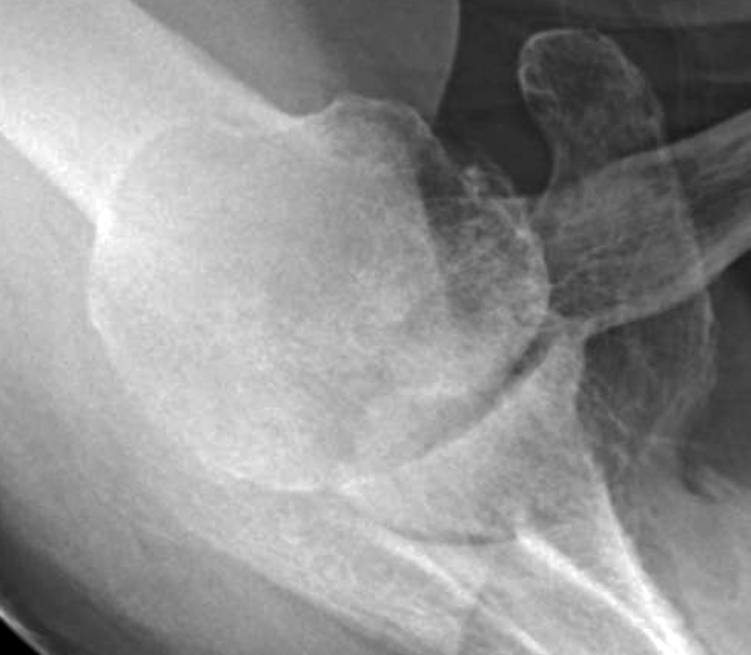 UW Shoulder and Elbow Academy: Shoulder joint replacement - many ...