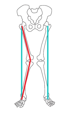 Portfólio Biomecânica: O que são joelhos valgo e varo?