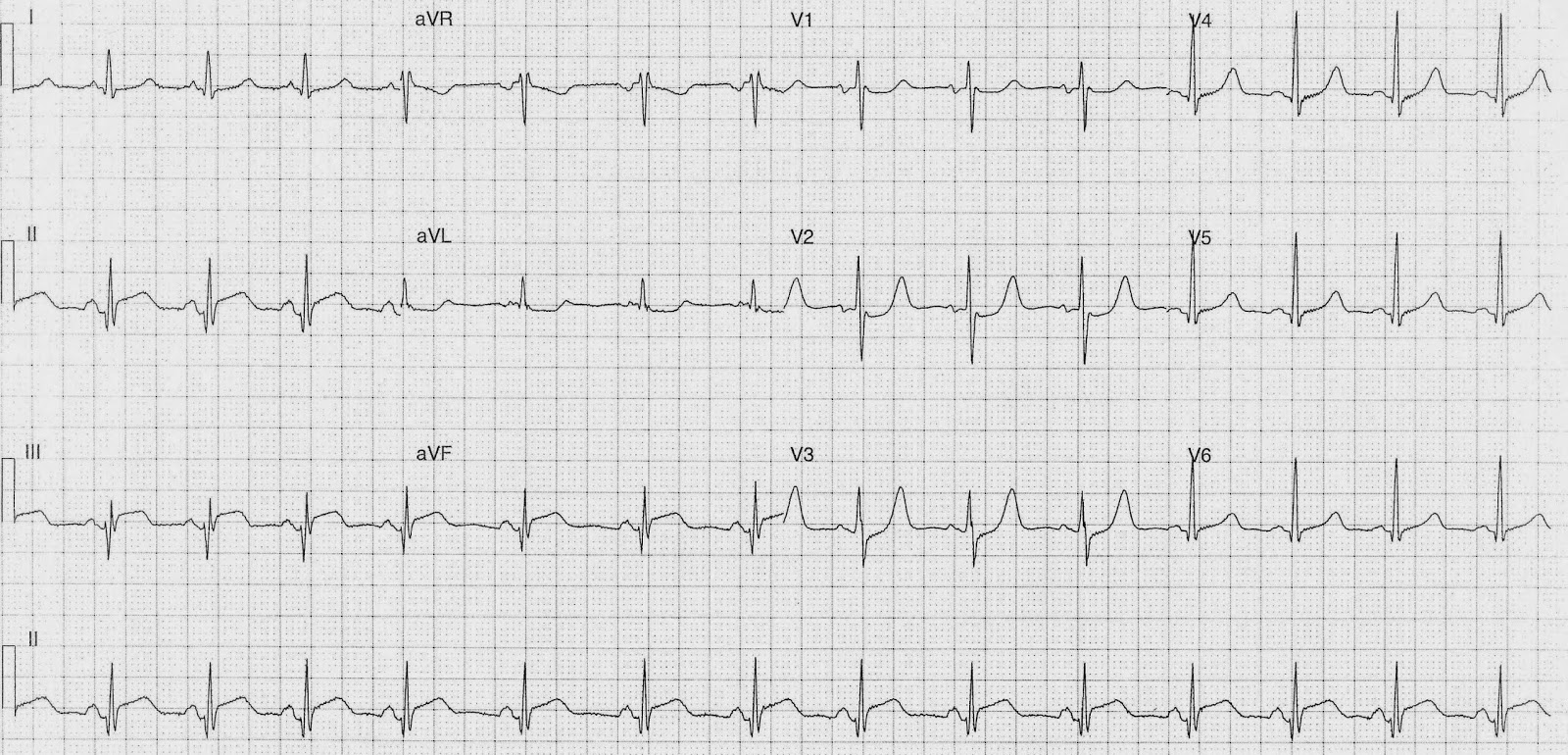 ECG of the Week: ECG of the Week - 11th May 2015 - Interpretation