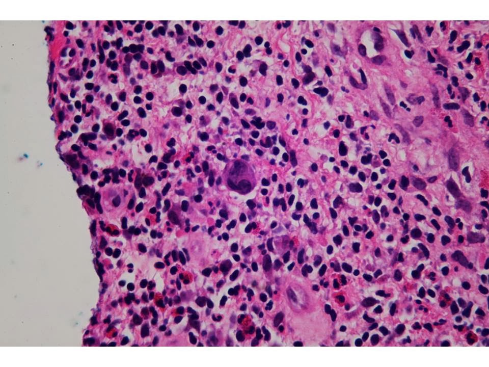 Dermpath Made Simple - Neoplastic: T and B cell lymphomas