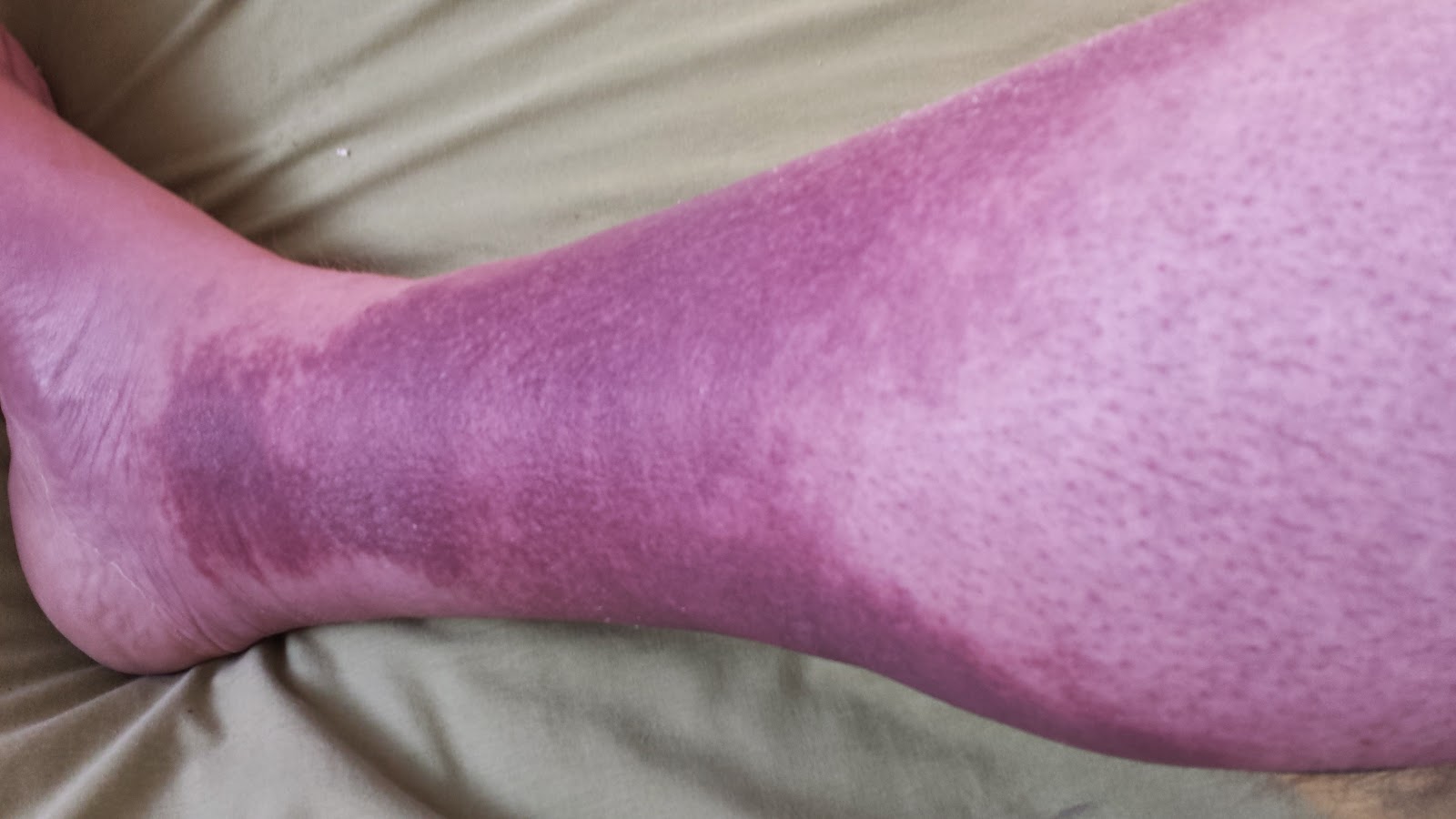 Cellulitis Infection