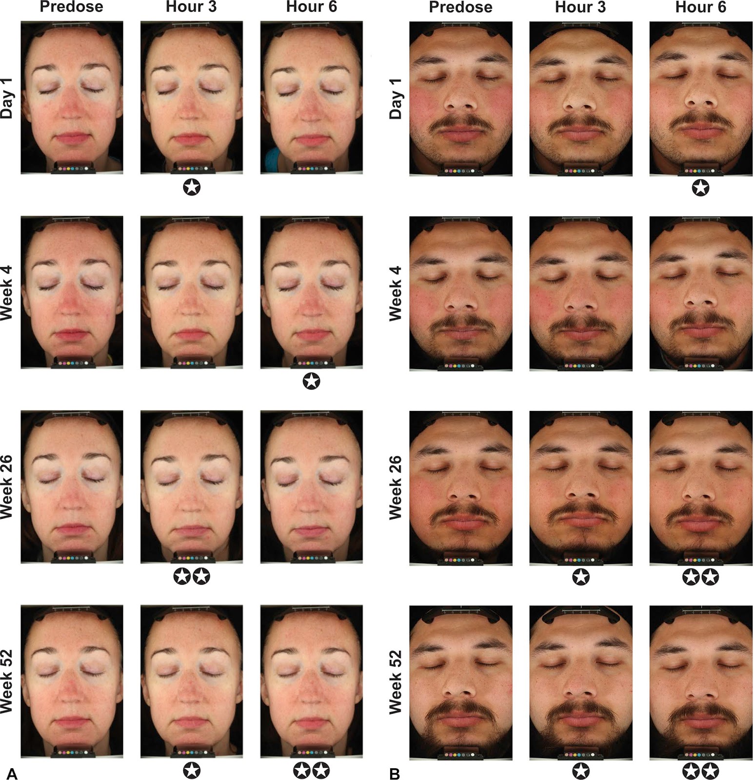 Scarlet Letters, dealing with vascular rosacea, face flushing, burning ...