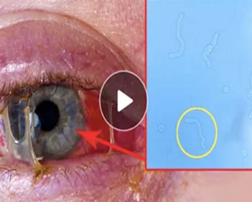 The Best Program: Gran infección en los ojos causa perder la vista