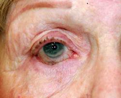 Entropion | Diseases