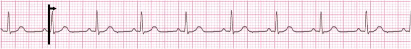 Dentistry and Medicine: ECG Rhythm Interpretation-How to Analyze a Rhythm