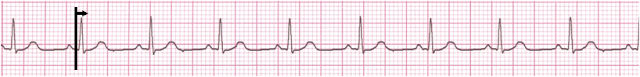 Dentistry and Medicine: ECG Rhythm Interpretation-How to Analyze a Rhythm