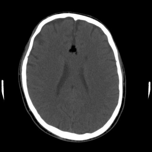 Post Gad: Interhemispheric lipoma vs. Fatty falx