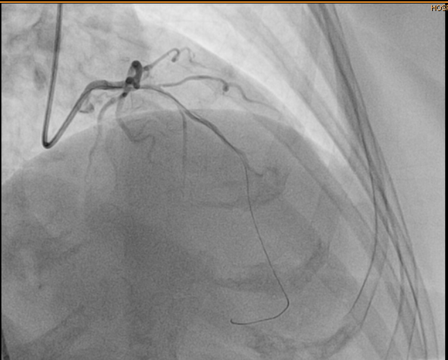 Hemodinamia ISSSTE regional Monterrey