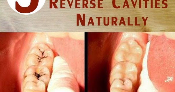 5 things to do to Reverse Cavities Naturally