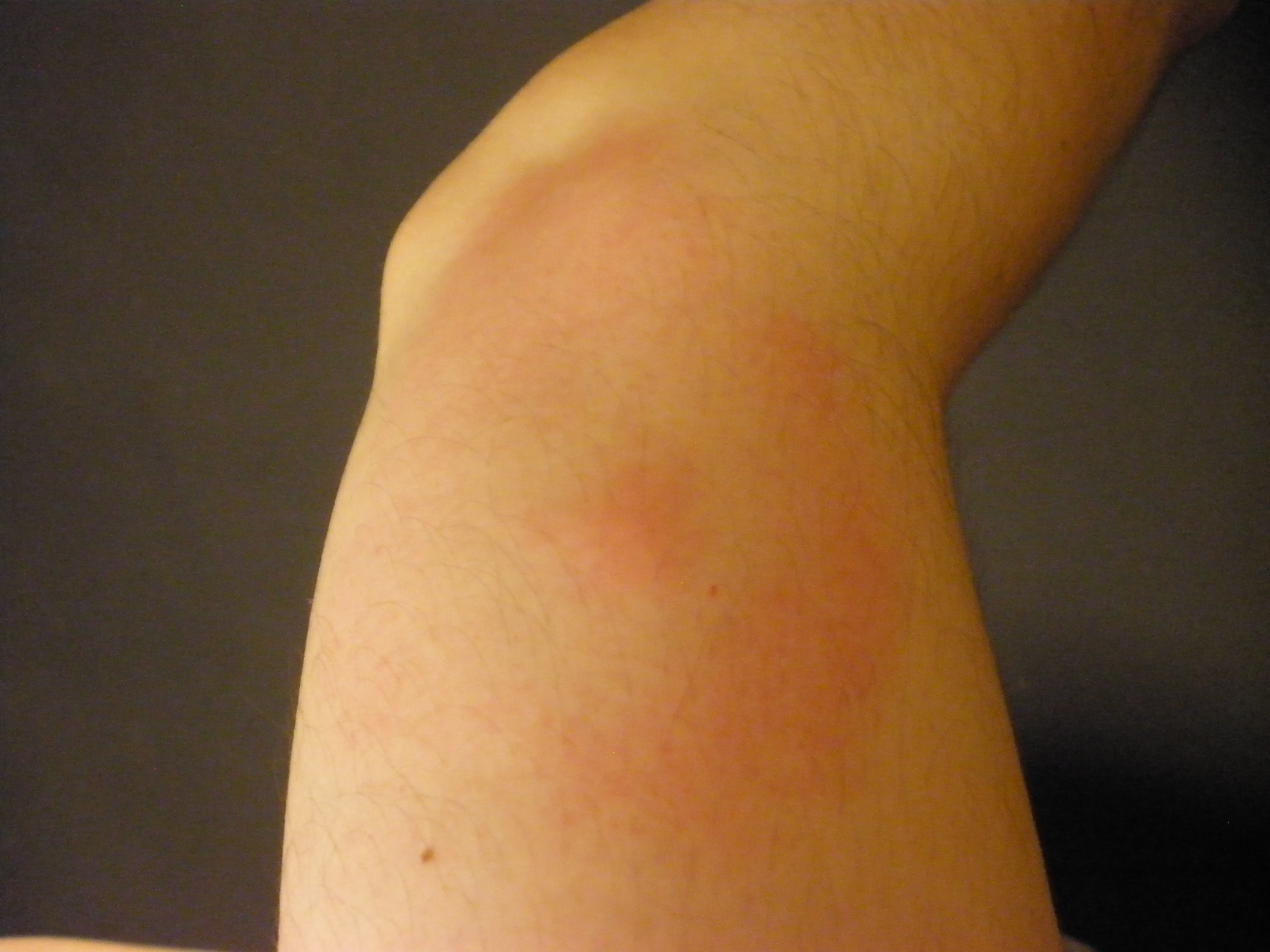 Hoohokekyo: skeeter syndrome