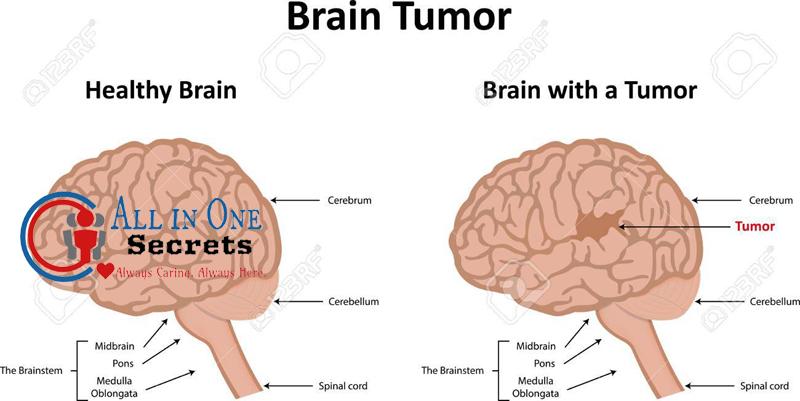 What is a Brain Tumor?: Causes, Symptoms,Classification - Live Healthy ...