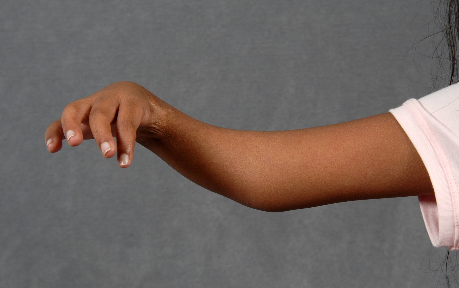 Recurrent Radial Longitudinal Deficiency | Congenital Hand and Arm ...