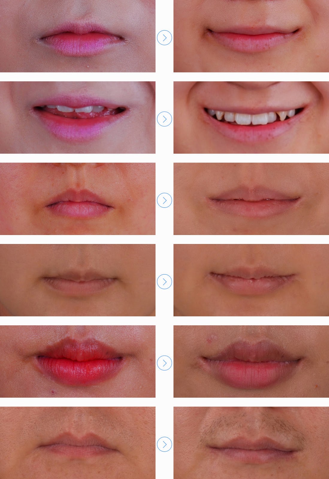 Senyum Abadi dengan 'Smile Lipt' ~ Cantik Dengan Teknologi