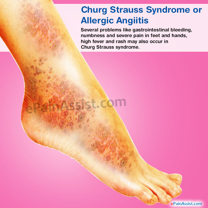 Churg-Strauss syndrome Diseases signs and symptoms Symptoms Treatments ...