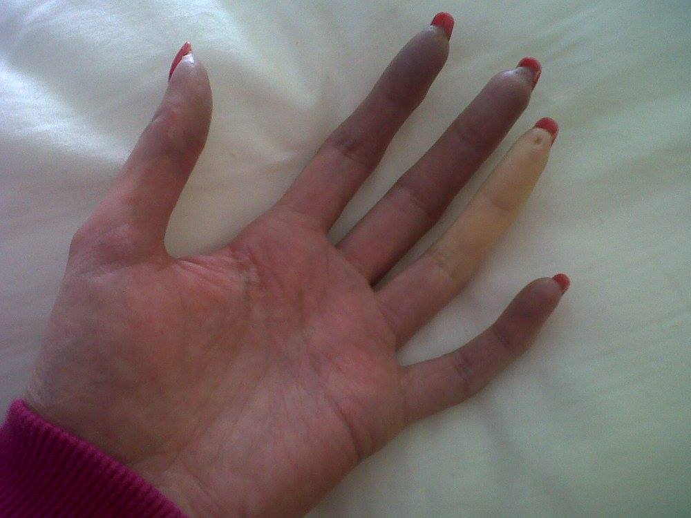 Raynauds Scleroderma Global Patients: DAY 7: Raynaud's phenomenon ...