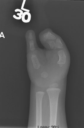 Central Deficiency with 2-3 fingers | Congenital Hand and Arm ...