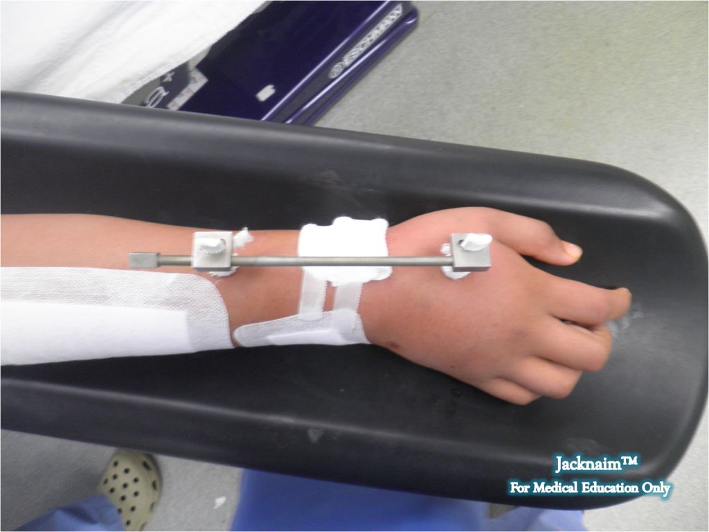 My Medical Notes: Wrist Distractor for Barton’s Fracture