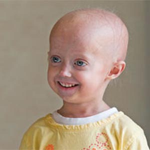 progeria