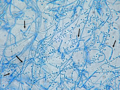 Fun With Microbiology (What's Buggin' You?): Trichophyton rubrum