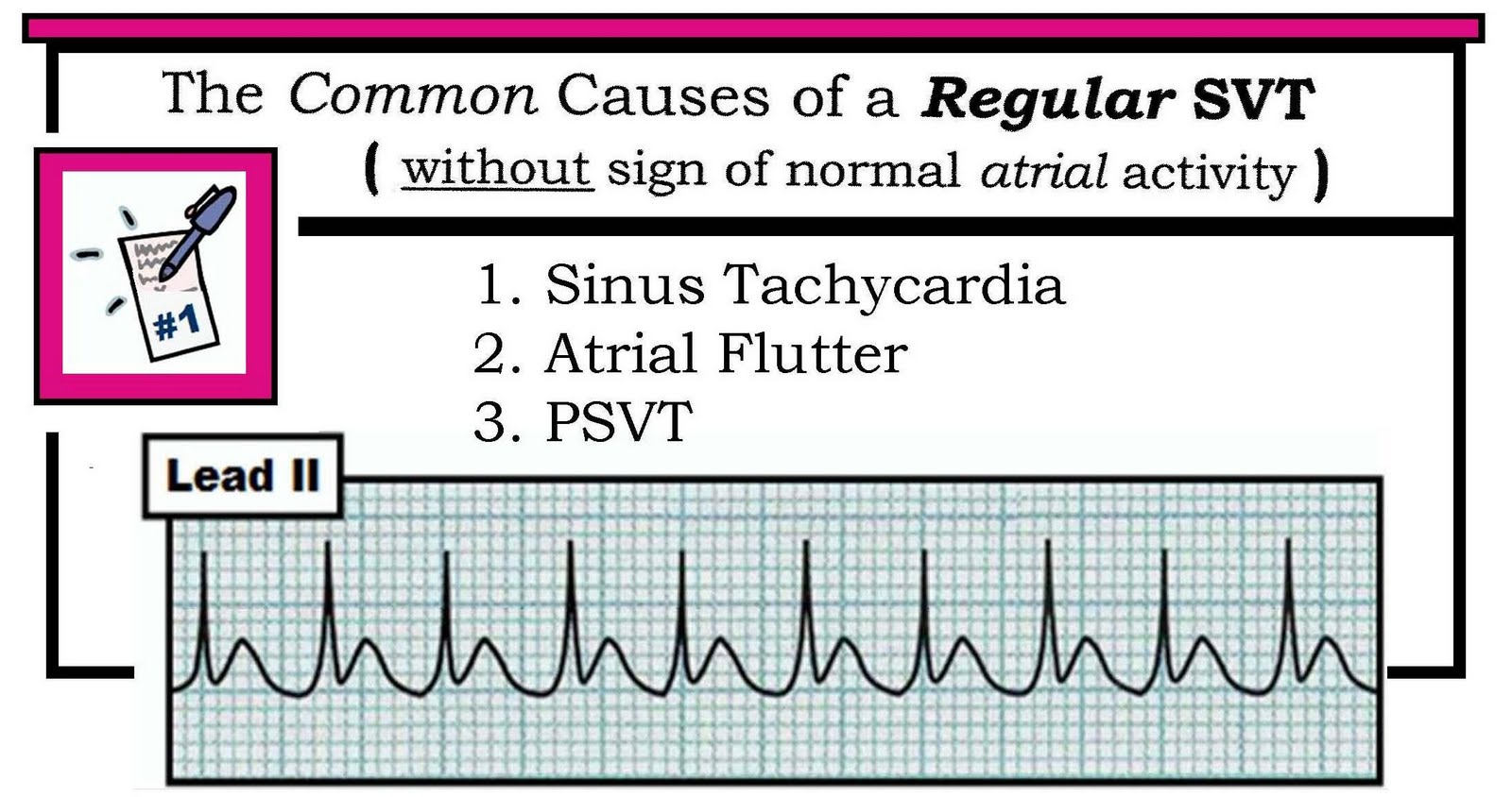 supraventricular tachycardia : 네이버 블로그