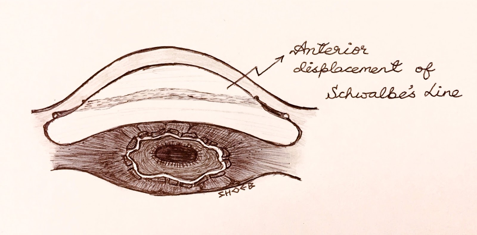 GLAUCOMA SPECIALIST BLOG: "THE GLOG"