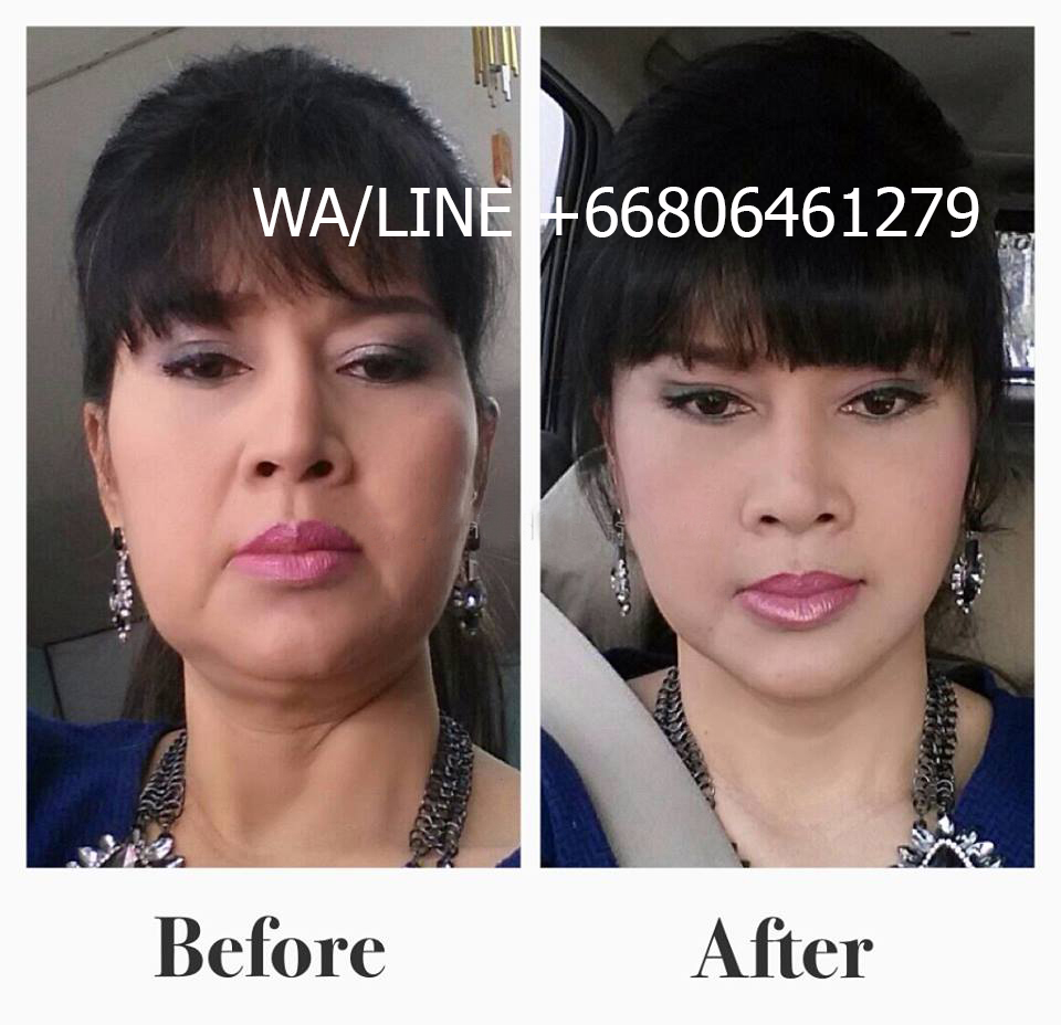 Bedah Plastik Di Bangkok: TARIK MUKA