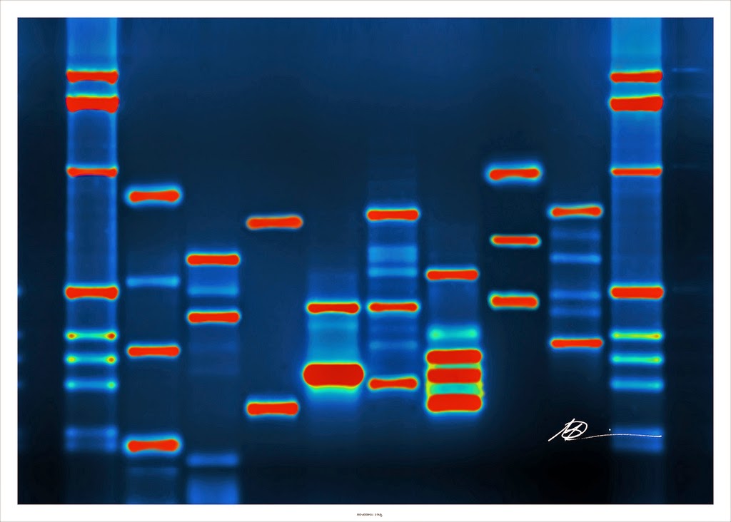 PALB2 Mutation: A "New" Gene That Greatly Increases Breast Cancer Risk ...