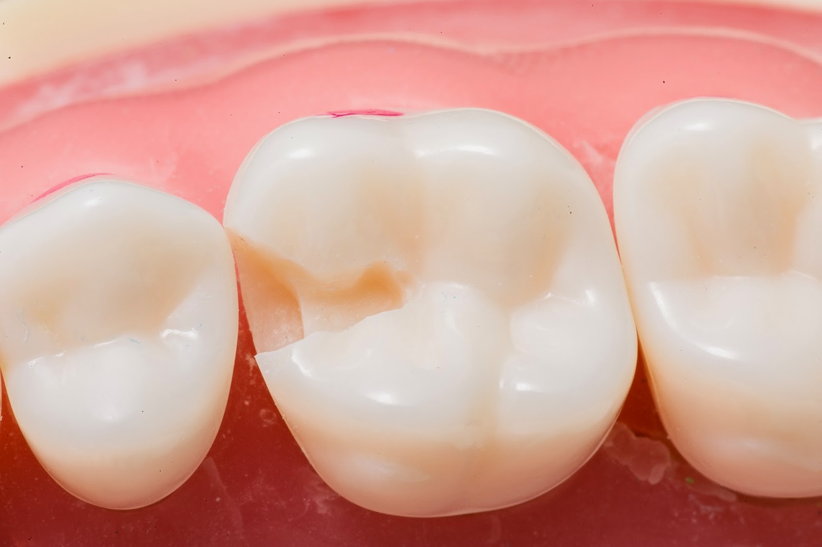 Becker Dental Portfolio: Tooth #14 MO Preparation