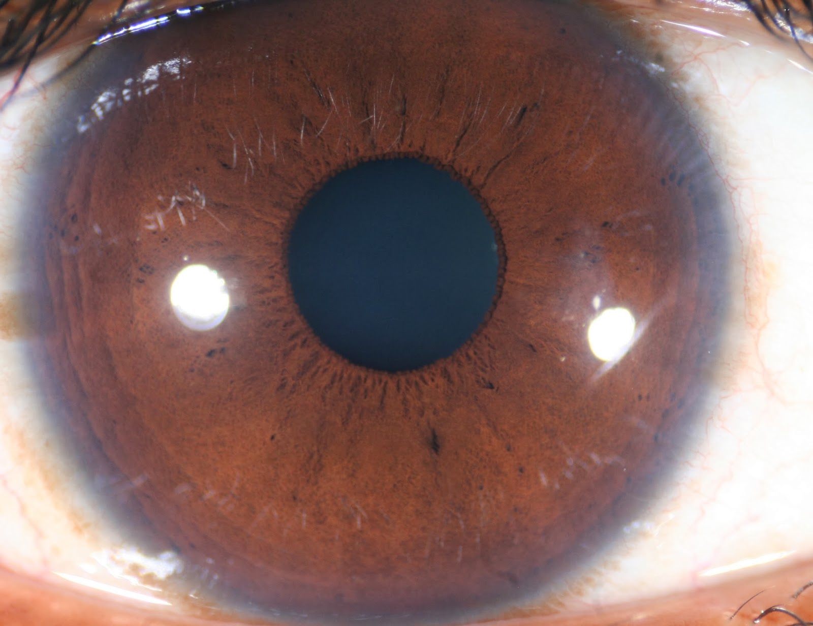 Modern & Multidimensional Iridology: Iris Signs on Neurogenic Structure ...