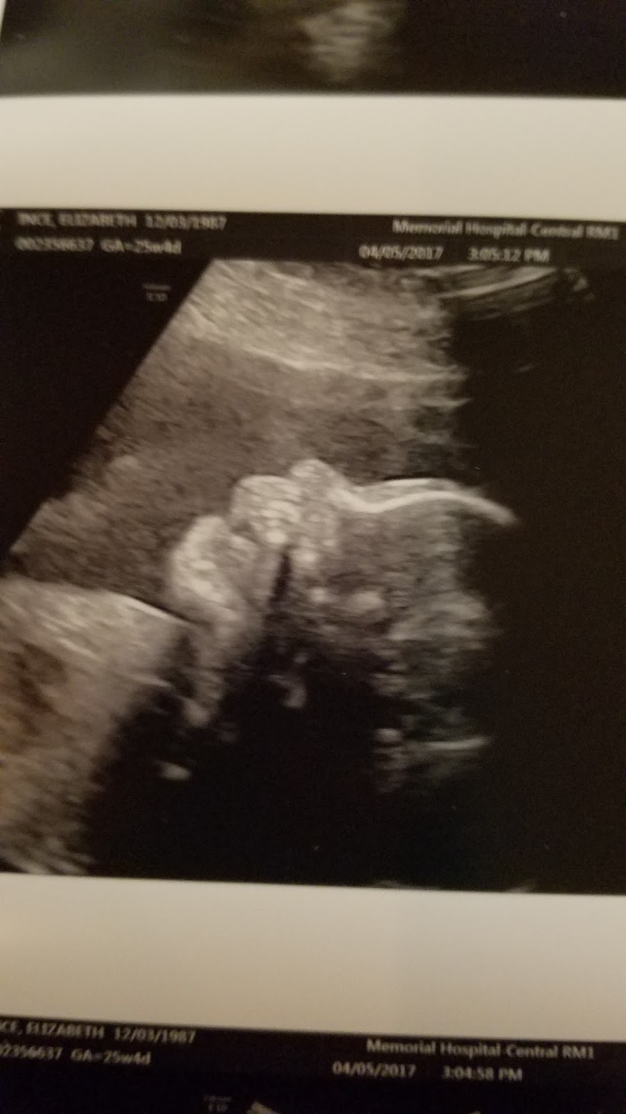 Our Surrogacy Journey: Fetal Echo/Growth scan
