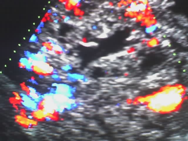 ULTRASSONOGRAFIA - Dr. Walter Lustosa Jr.: Mola Invasora