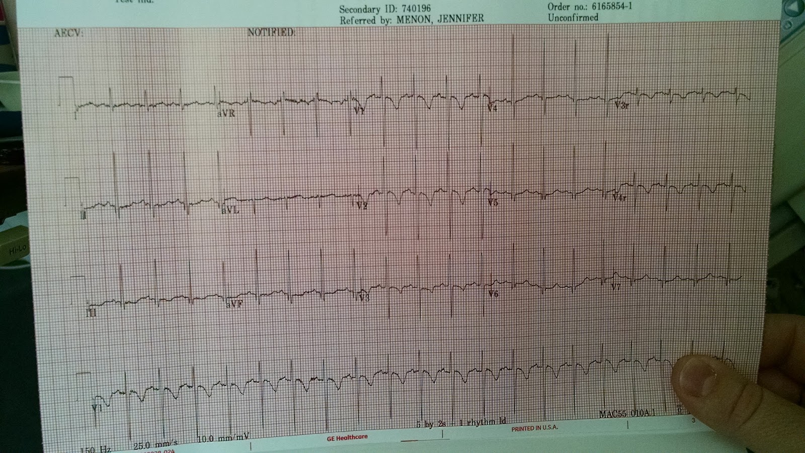 The Story of a Baby with SVT(PJRT)