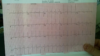 The Story of a Baby with SVT(PJRT)