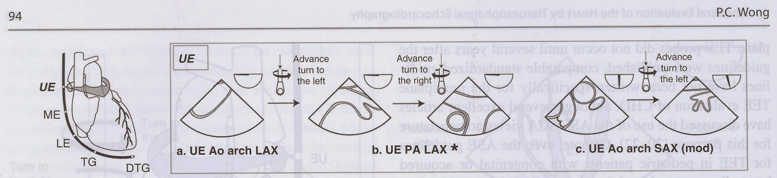 Pedi cardiology: TEE - Basic Views & terminology
