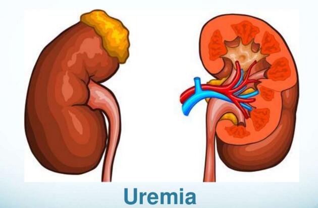 treatment for kidney disease: Warning Signs of Uremia