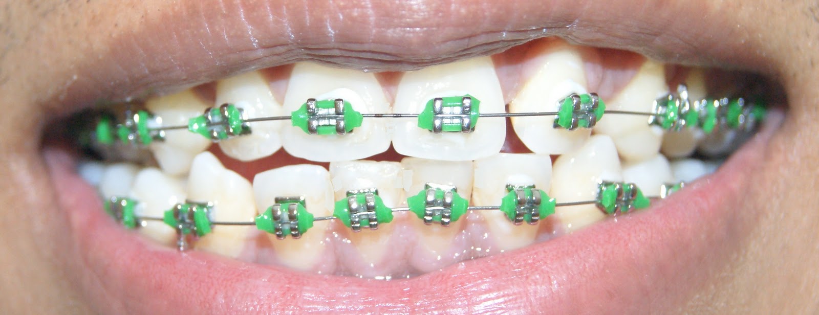 Mr Braces 7Eleven: Appt Tukar Getah Braces - Hijau