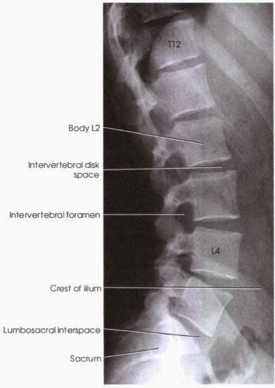 LATERAL POSITION: LUMBAR SPINE - RadTechOnDuty