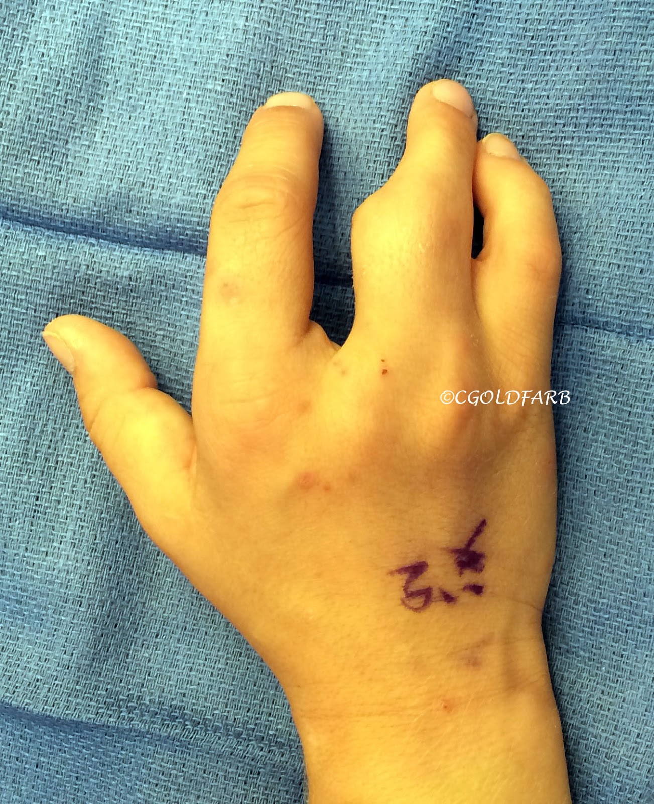 Cleft Hand Reconstruction | Congenital Hand and Arm Differences ...