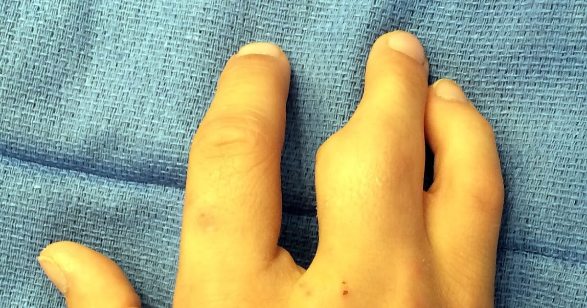 Cleft Hand Reconstruction | Congenital Hand and Arm Differences